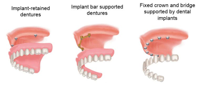 Denture Stabilisation ﻿﻿| Dental Implants Tonbridge
