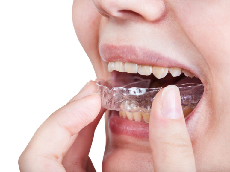 Botox for Jaw - TMJ Disorder in Tonbridge - Michigan Splint